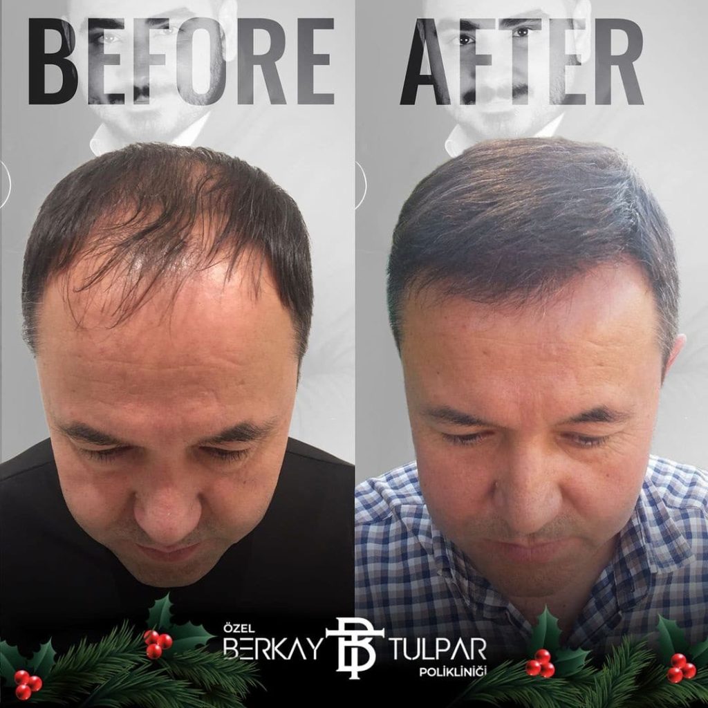 Beard Transplantation | Berkay Tulpar
